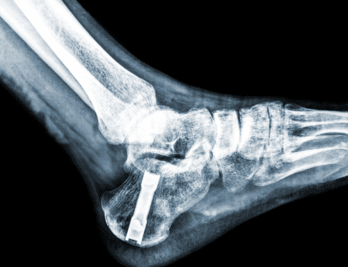 Hindfoot Fusion Explained: What to Expect and Key Benefits