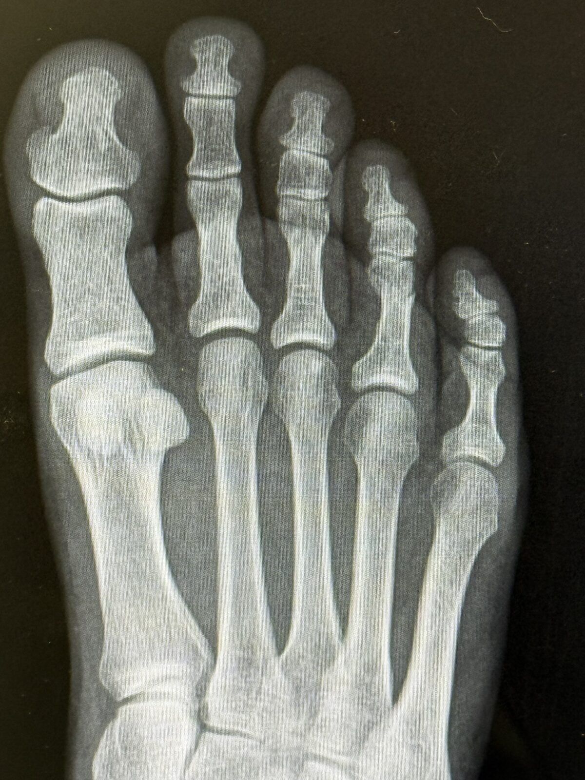 Small Toe Fractures - Flint Foot & Ankle Institute