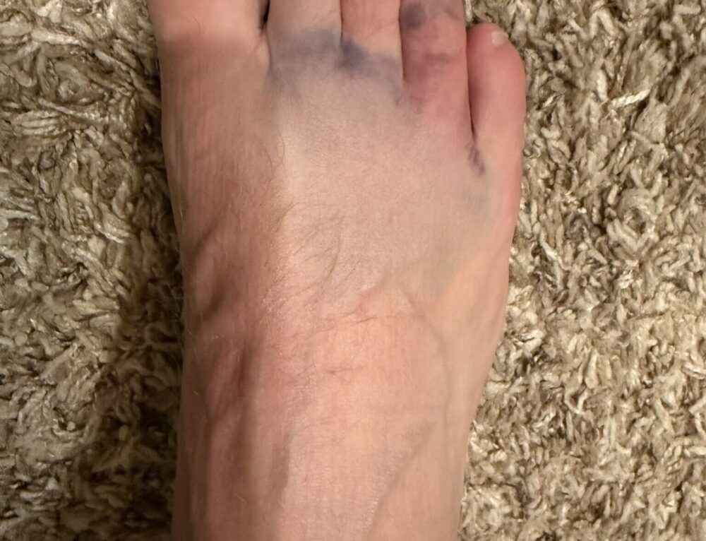 4 Common Toe Deformities and How to Treat Them